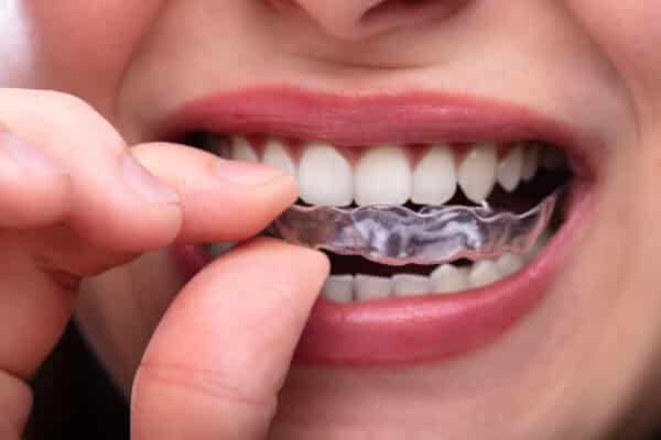 4 Steps To Take When Your Invisalign Doesn’t Fit | Bailey Orthodontics